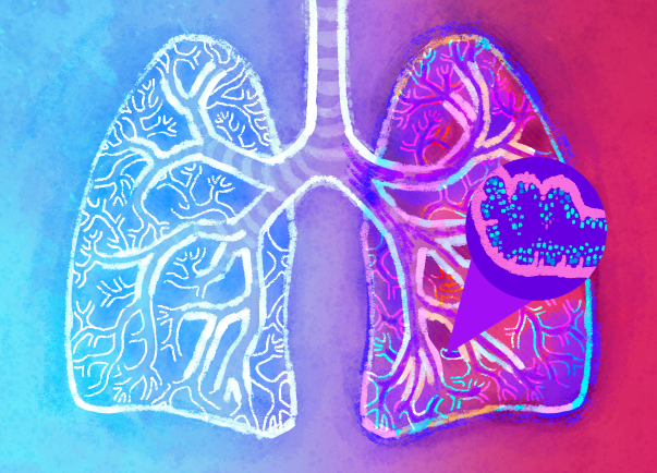 Pacienti ar cistisko fibrozi beidzot saņem inovatīvas valsts apmaksātas ...